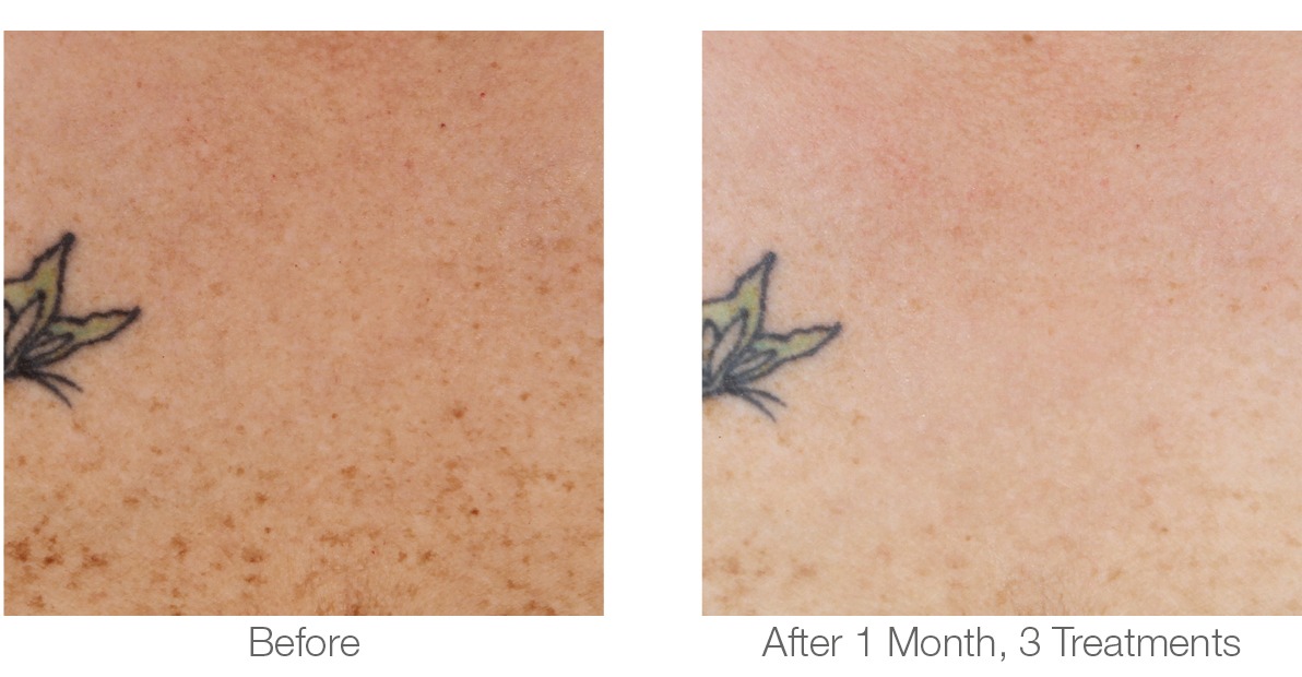 Light & Bright Treatment in Lake County, IL