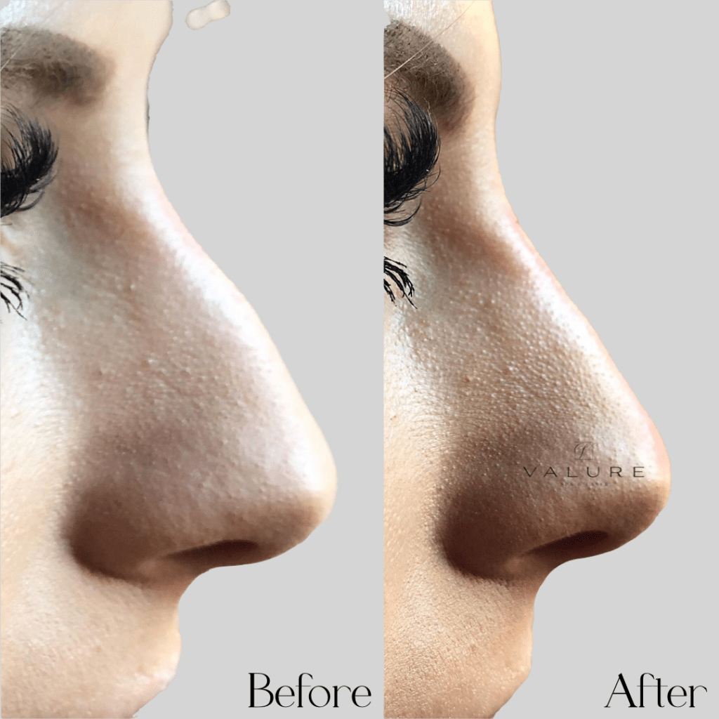 Dermal Fillers in Lake County, IL